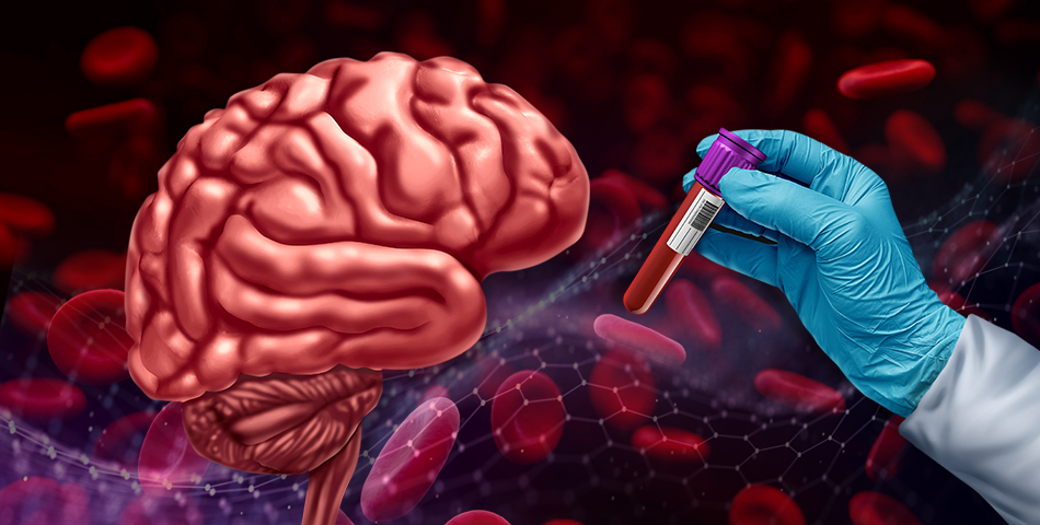 Biomarkers in Alzheimer's Disease