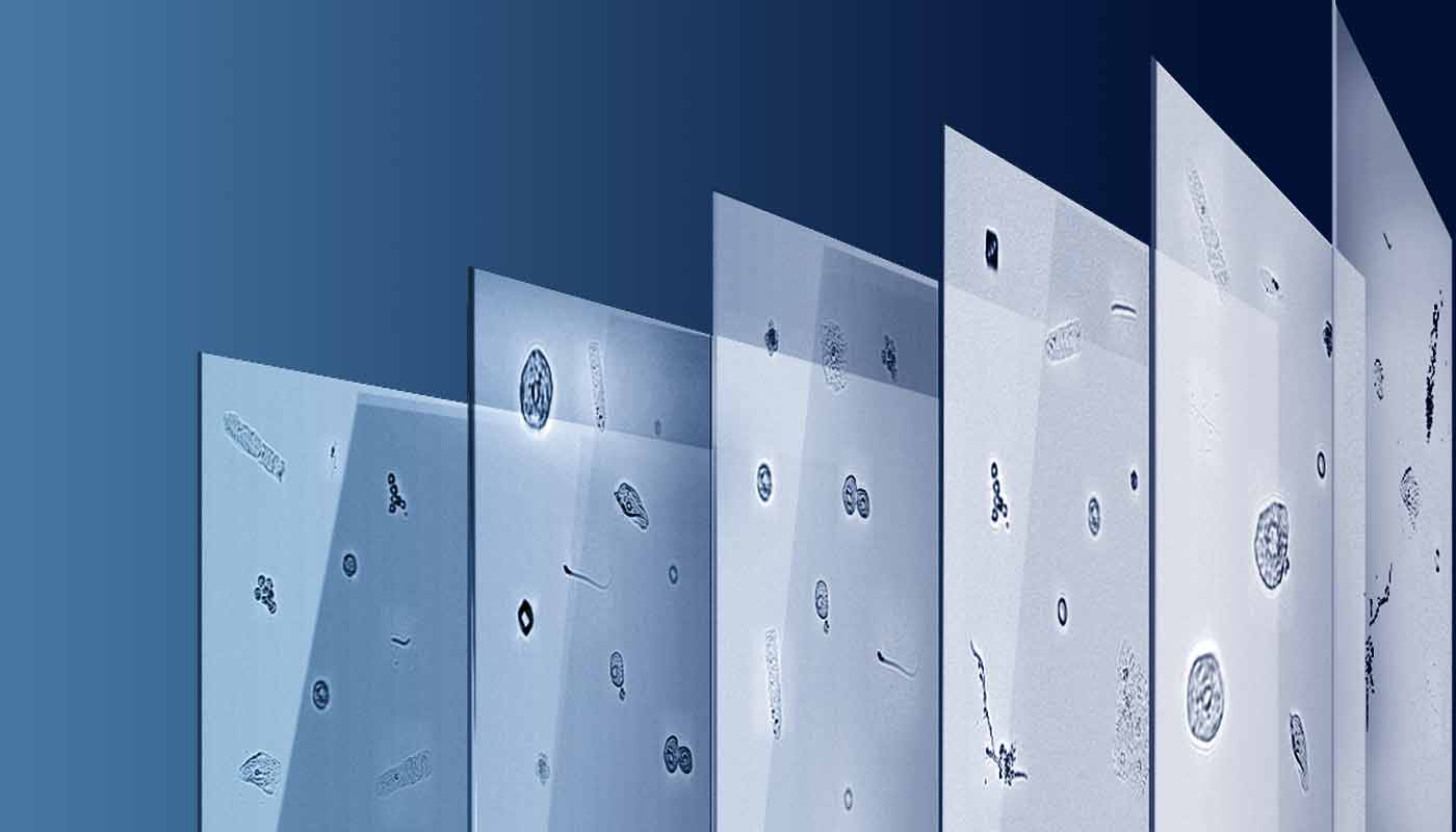 Automated Urinalysis Reduces Microscopic Reviews by 63% | Beckman Coulter